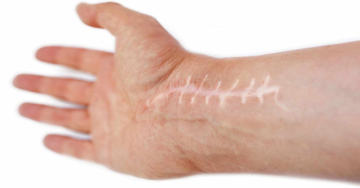Indianapolis Scarring & Disfigurement Injury Attorney